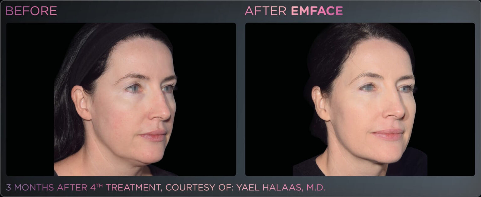 Das erste nicht-invasive, nadelfreie Facelift der Welt | EMFACE