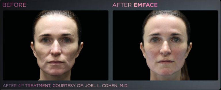 Das erste nicht-invasive, nadelfreie Facelift der Welt | EMFACE