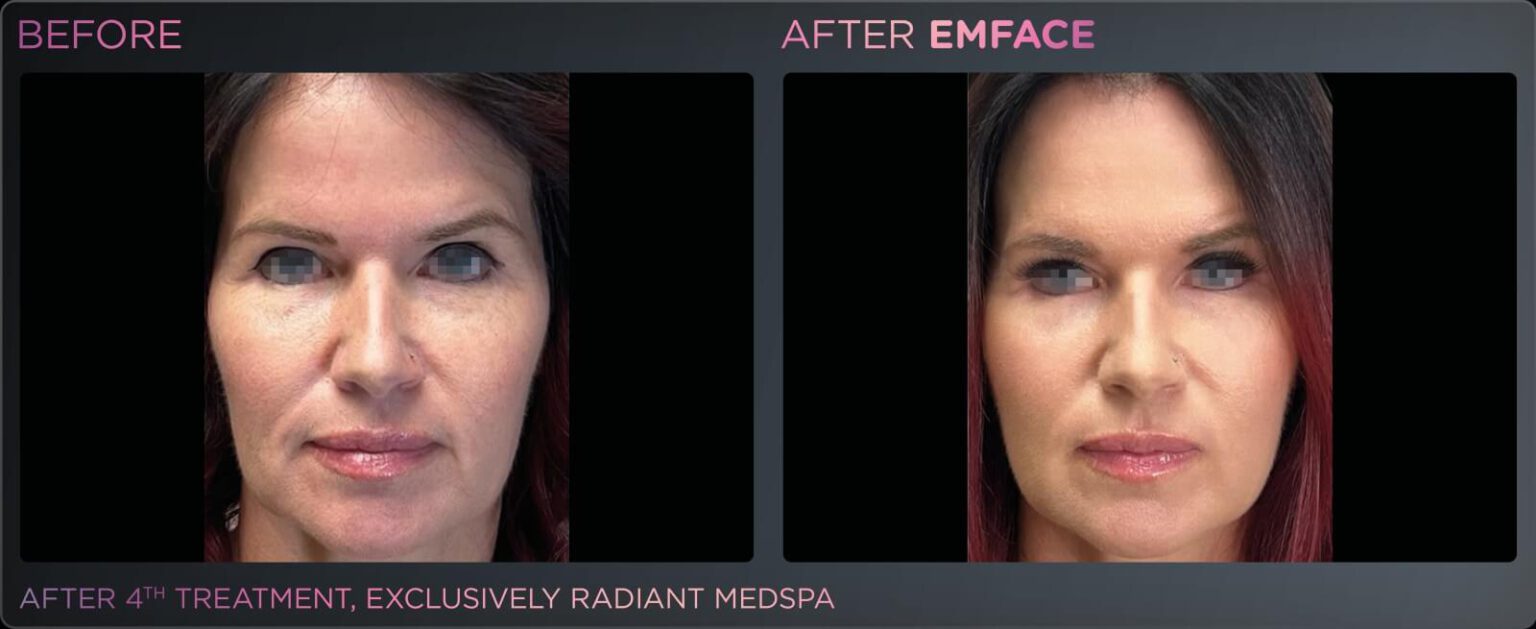 Das erste nicht-invasive, nadelfreie Facelift der Welt | EMFACE