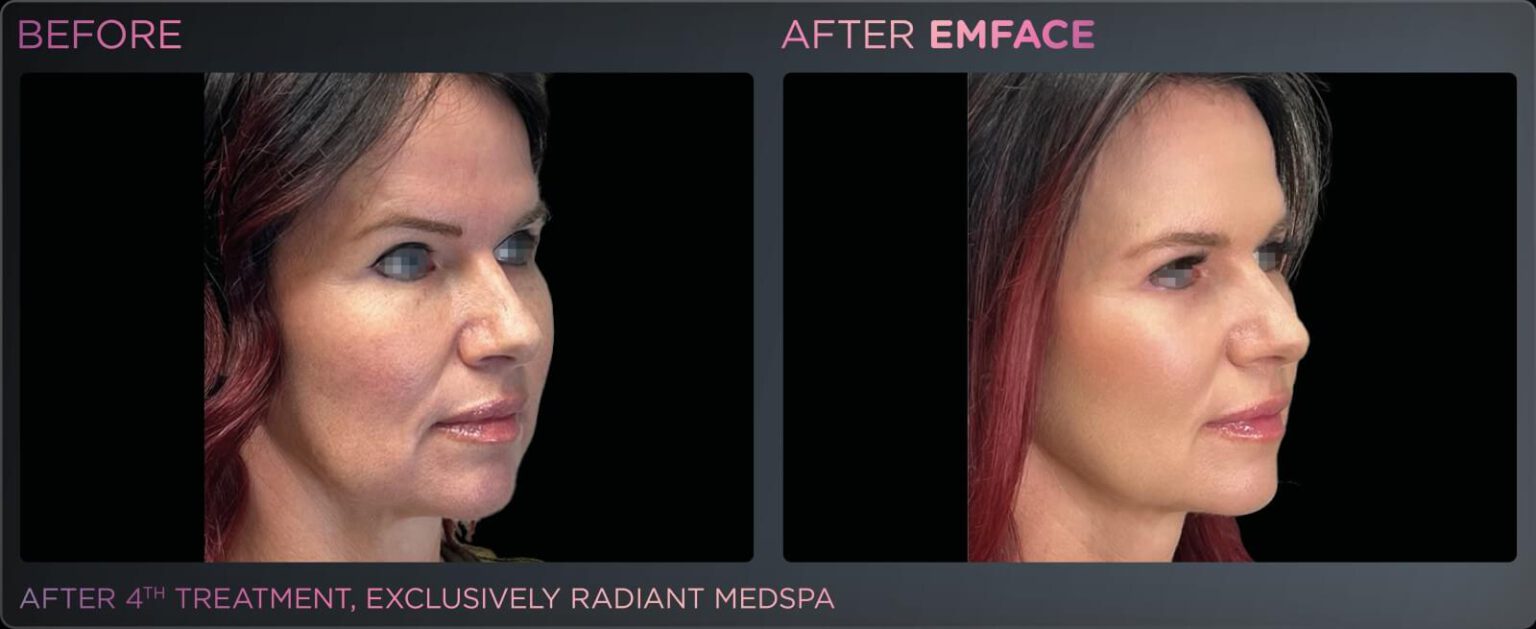 Das erste nicht-invasive, nadelfreie Facelift der Welt | EMFACE