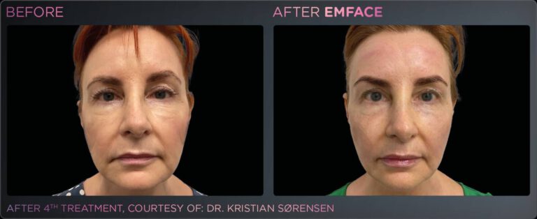 Das erste nicht-invasive, nadelfreie Facelift der Welt | EMFACE