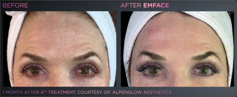 Das erste nicht-invasive, nadelfreie Facelift der Welt | EMFACE