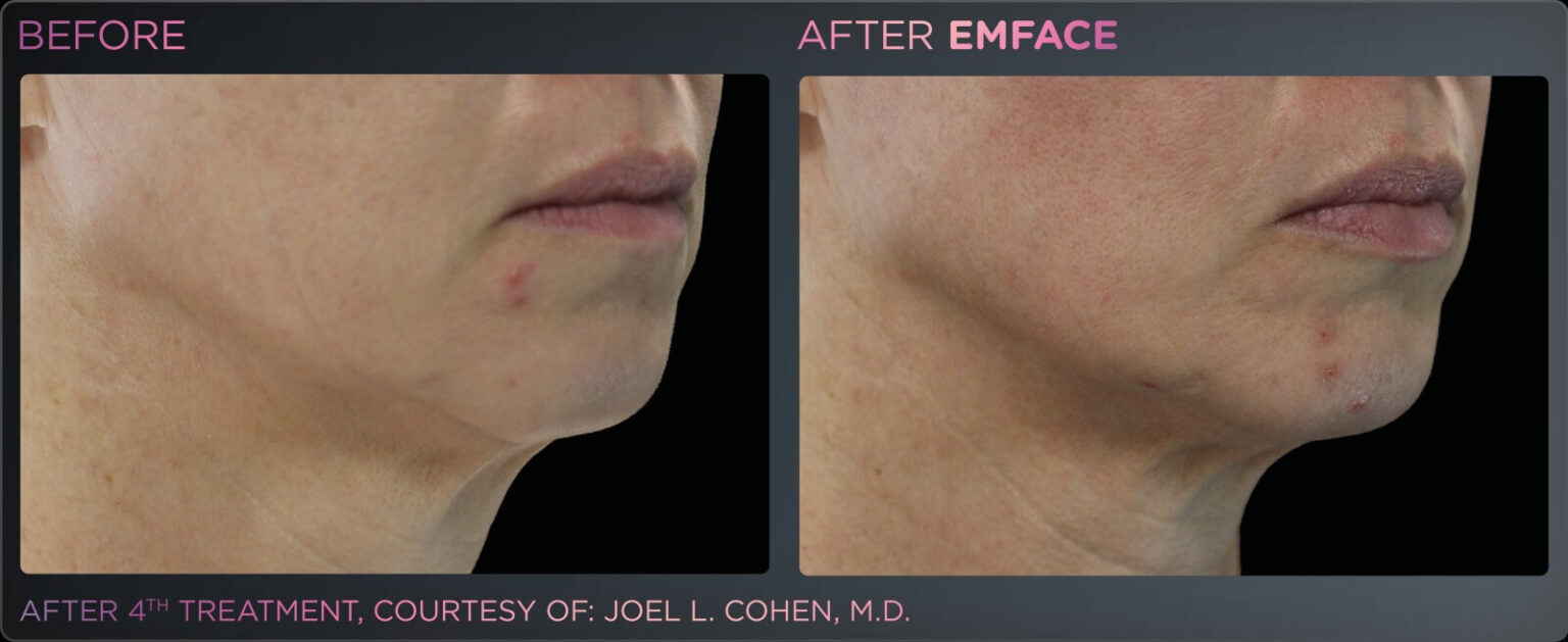 Das erste nicht-invasive, nadelfreie Facelift der Welt | EMFACE