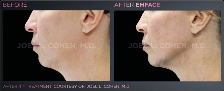 Das erste nicht-invasive, nadelfreie Facelift der Welt | EMFACE