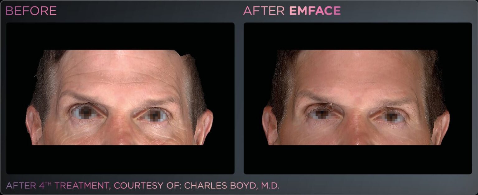 Das erste nicht-invasive, nadelfreie Facelift der Welt | EMFACE